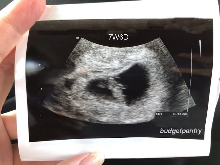 Pregnancy #2: A flickering heartbeat at my 6W5D ultrasound scan ⋆ Budgetpantry | Singapore Mummy ...